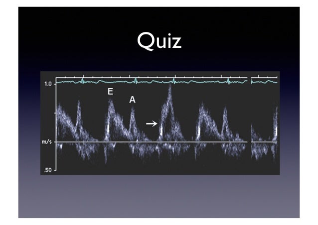 Echocardiographic Evaluation Of Lv Diastolic Function