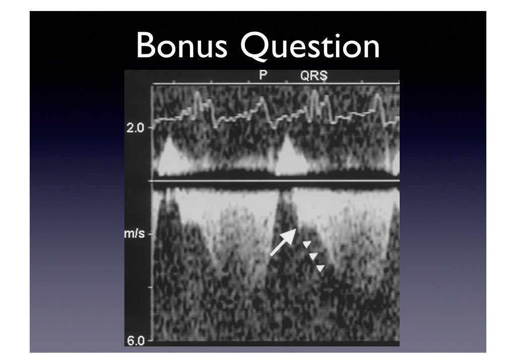 Echocardiographic Evaluation Of Lv Diastolic Function