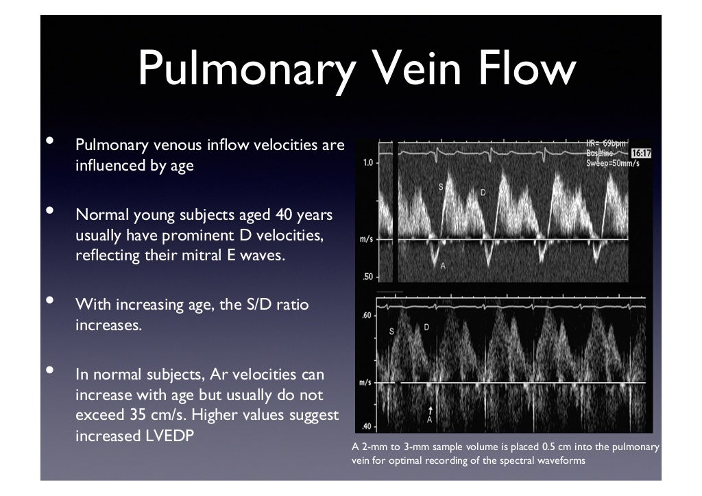 Echocardiographic Evaluation Of Lv Diastolic Function