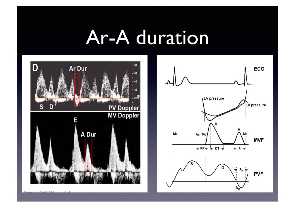 Echocardiographic Evaluation Of Lv Diastolic Function