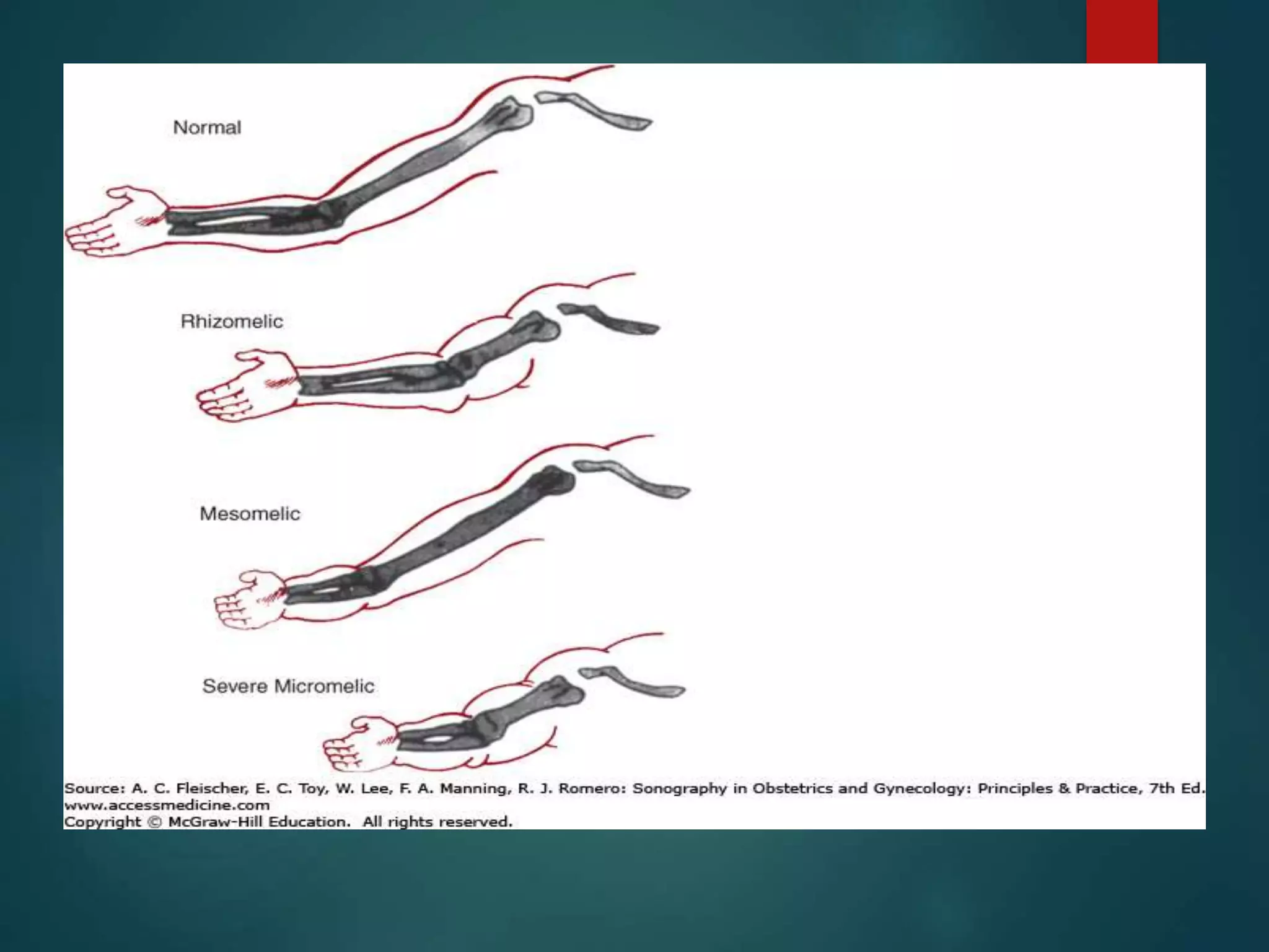 Diastrophic dysplasia | PPTX