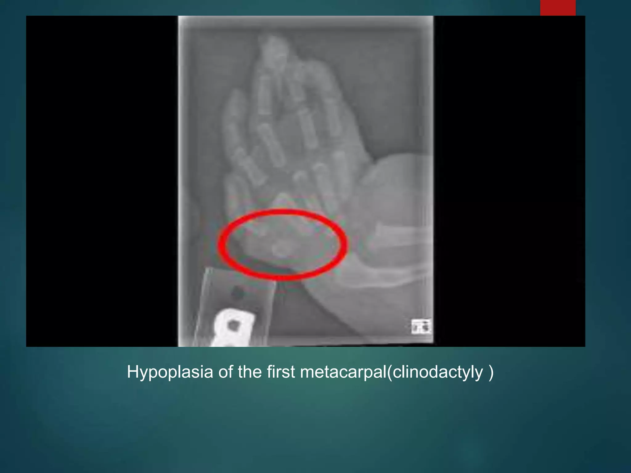 Diastrophic dysplasia | PPTX