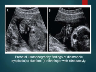 Diastrophic dysplasia | PPTX