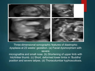 Diastrophic dysplasia | PPTX