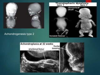 Diastrophic dysplasia | PPTX