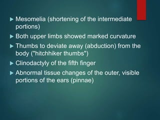 Diastrophic dysplasia | PPTX