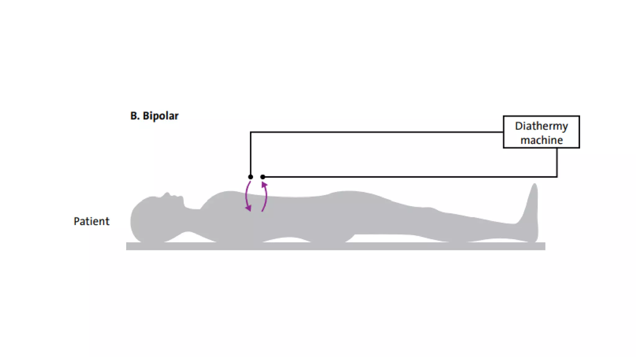Diathermy - Electrocautery | PDF