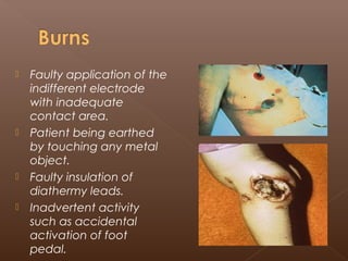 Diathermy in Surgery | PPT