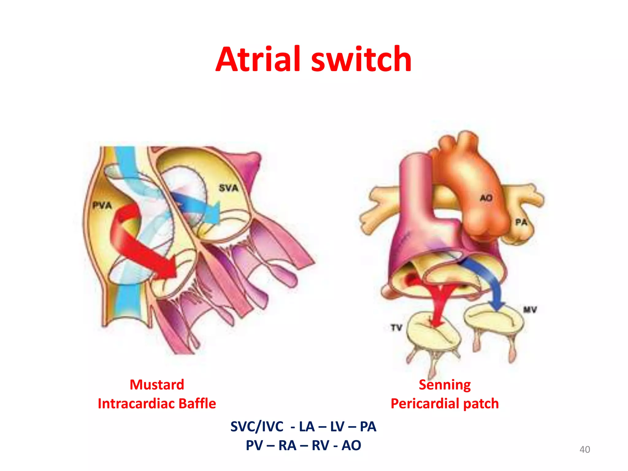 surgical approach of cyanotic congenital heart disease | PPTX