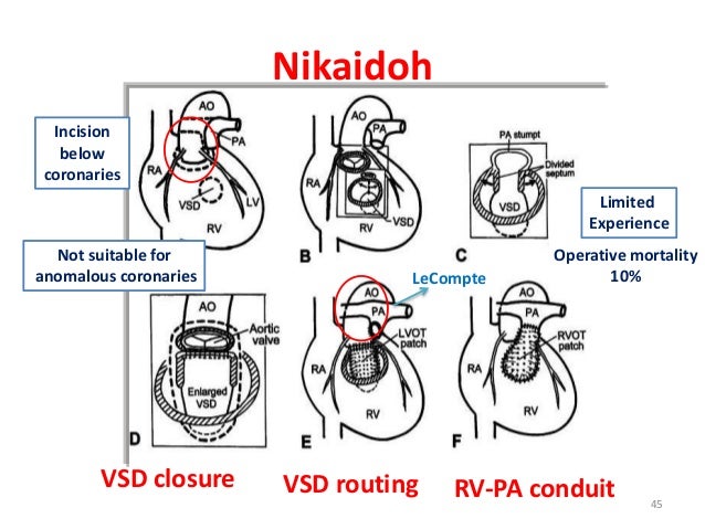 surgical approach of cyanotic congenital heart disease