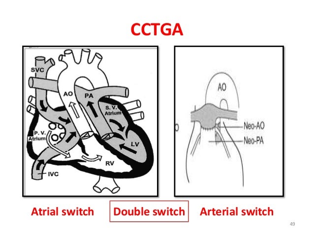 surgical approach of cyanotic congenital heart disease
