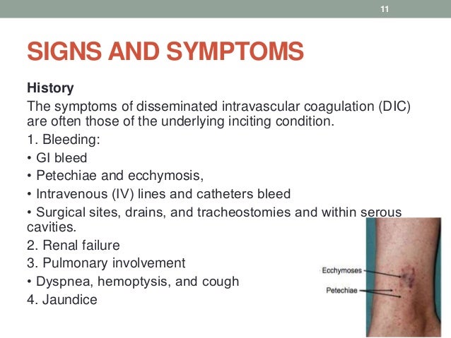 Disseminated Intravascular Coagulation