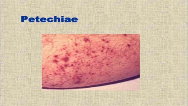 Dic- disseminated intravascular coagulation | PPTX | Blood Disorders ...