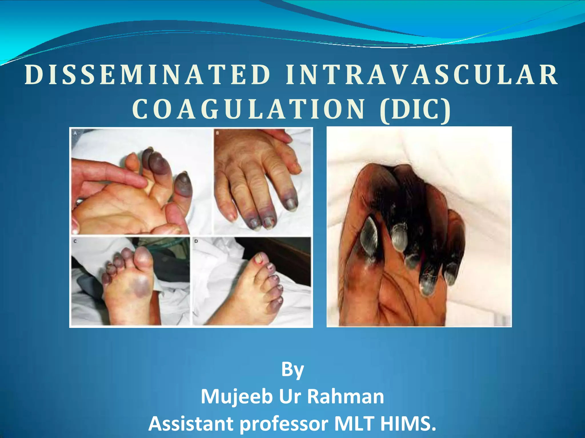 Disseminated intravascular coagulation | PPTX | Blood Disorders | Diseases and Conditions