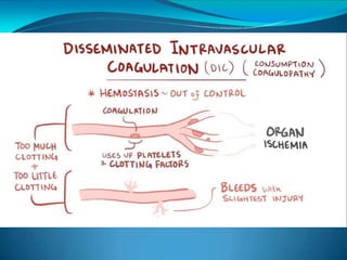 Disseminated intravascular coagulation | PPTX