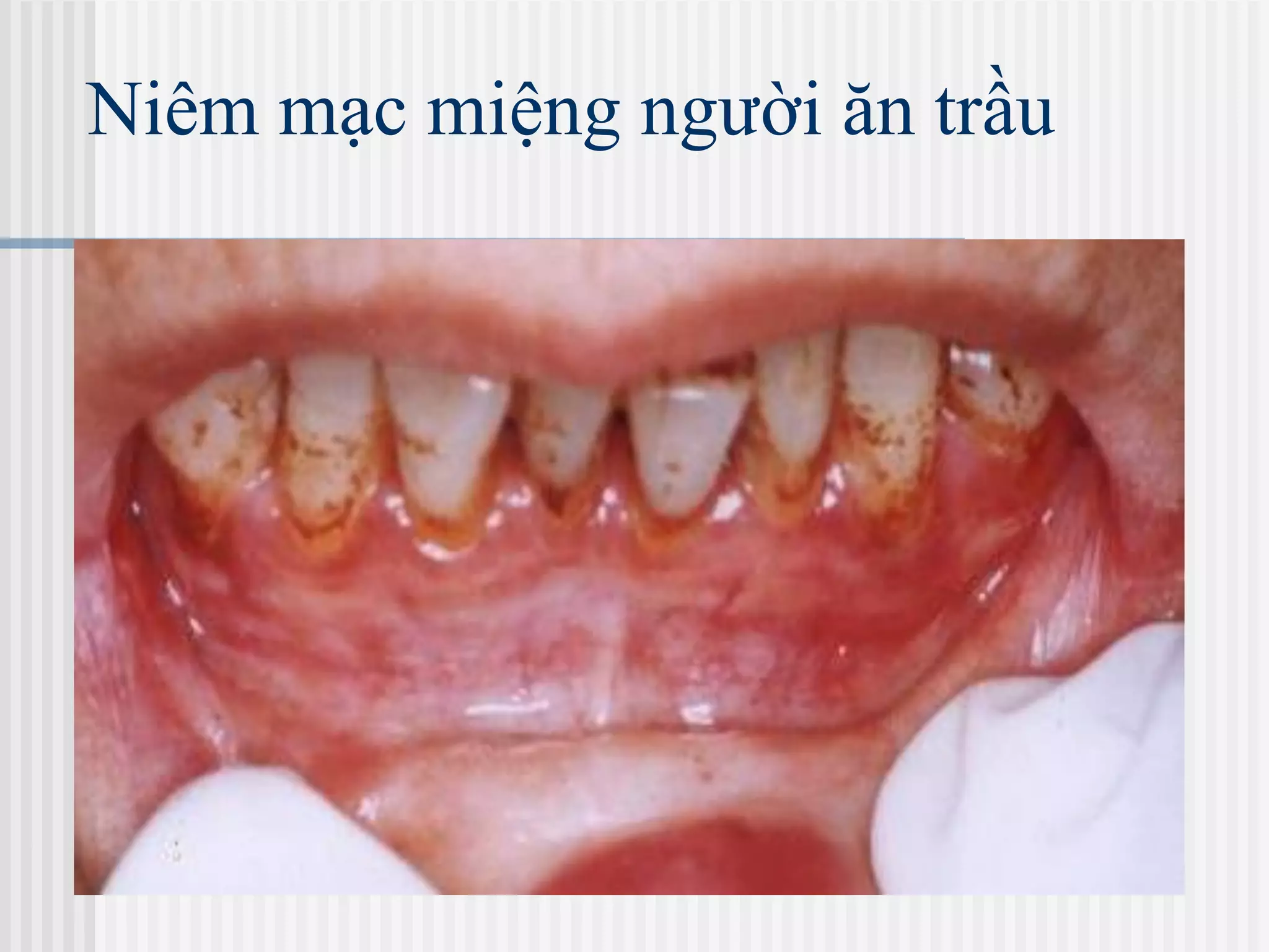 Dich te hoc va phong ngua benh rang mieng | PDF