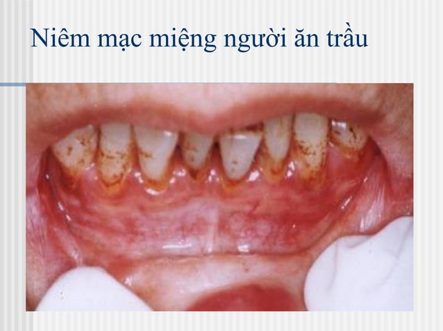 Dich te hoc va phong ngua benh rang mieng | PDF