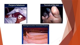 Pathophysiology, Pathogenesis and Laboratory diagnois of DIC | PPTX