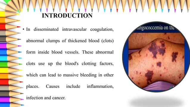 Disseminated intravascular coagulopathy | PPTX | First Aid | Injuries