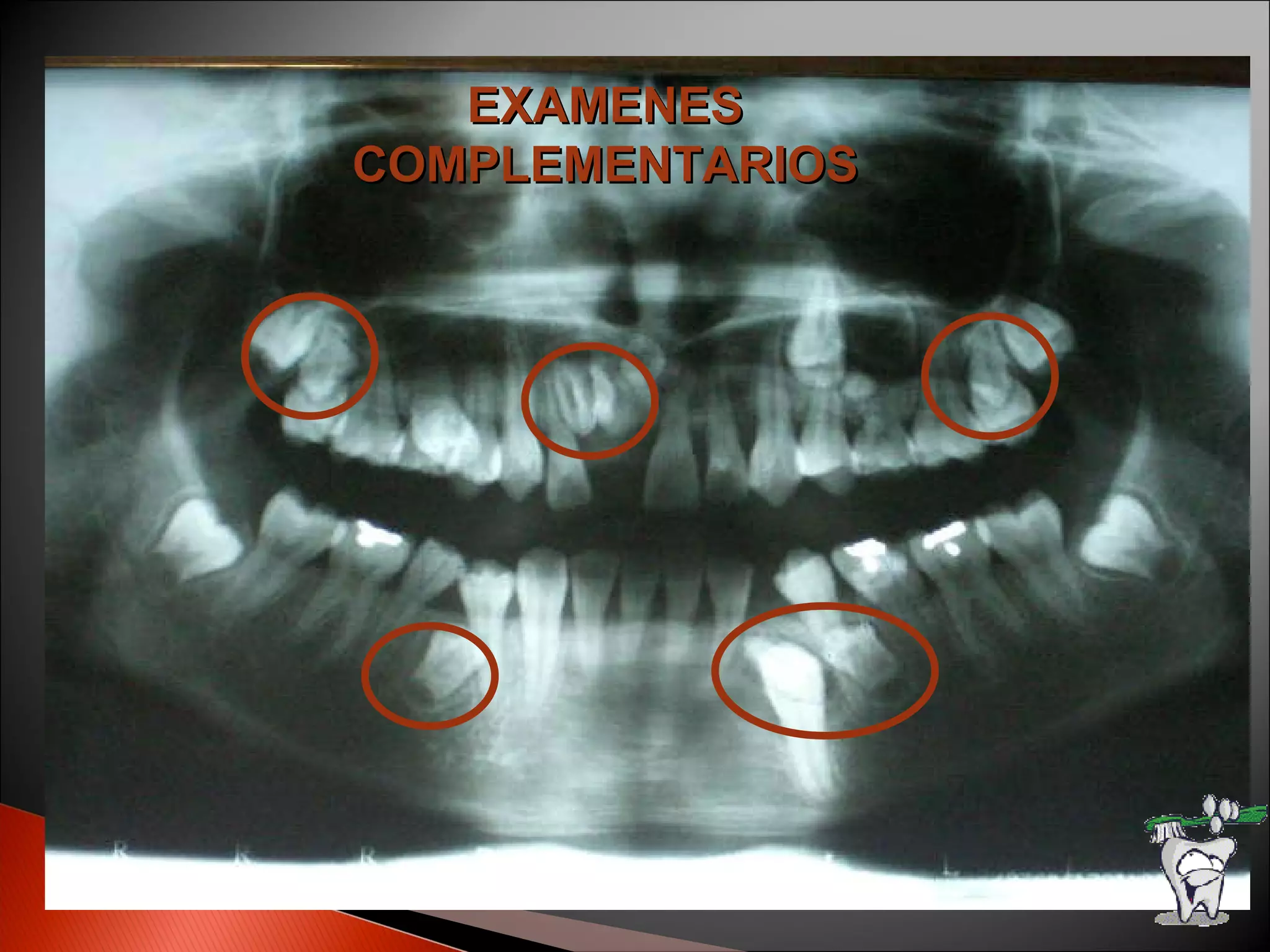 Dientes supernumerarios | PPS | Dental Health | Diseases and Conditions