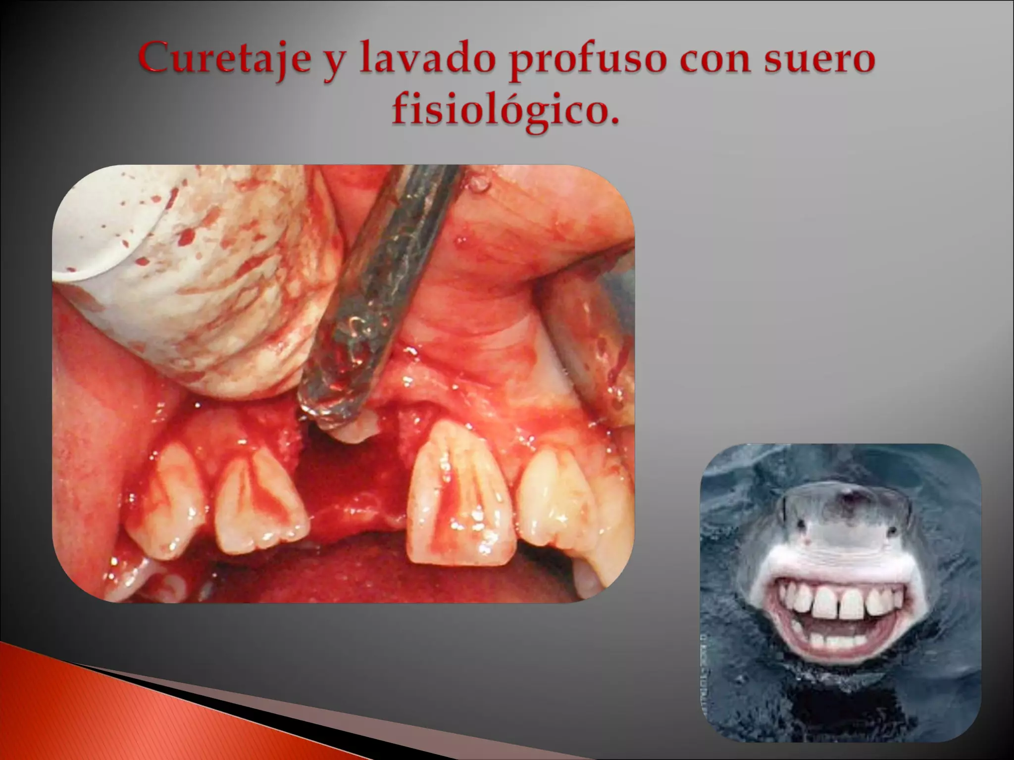 Dientes supernumerarios | PPS | Dental Health | Diseases and Conditions