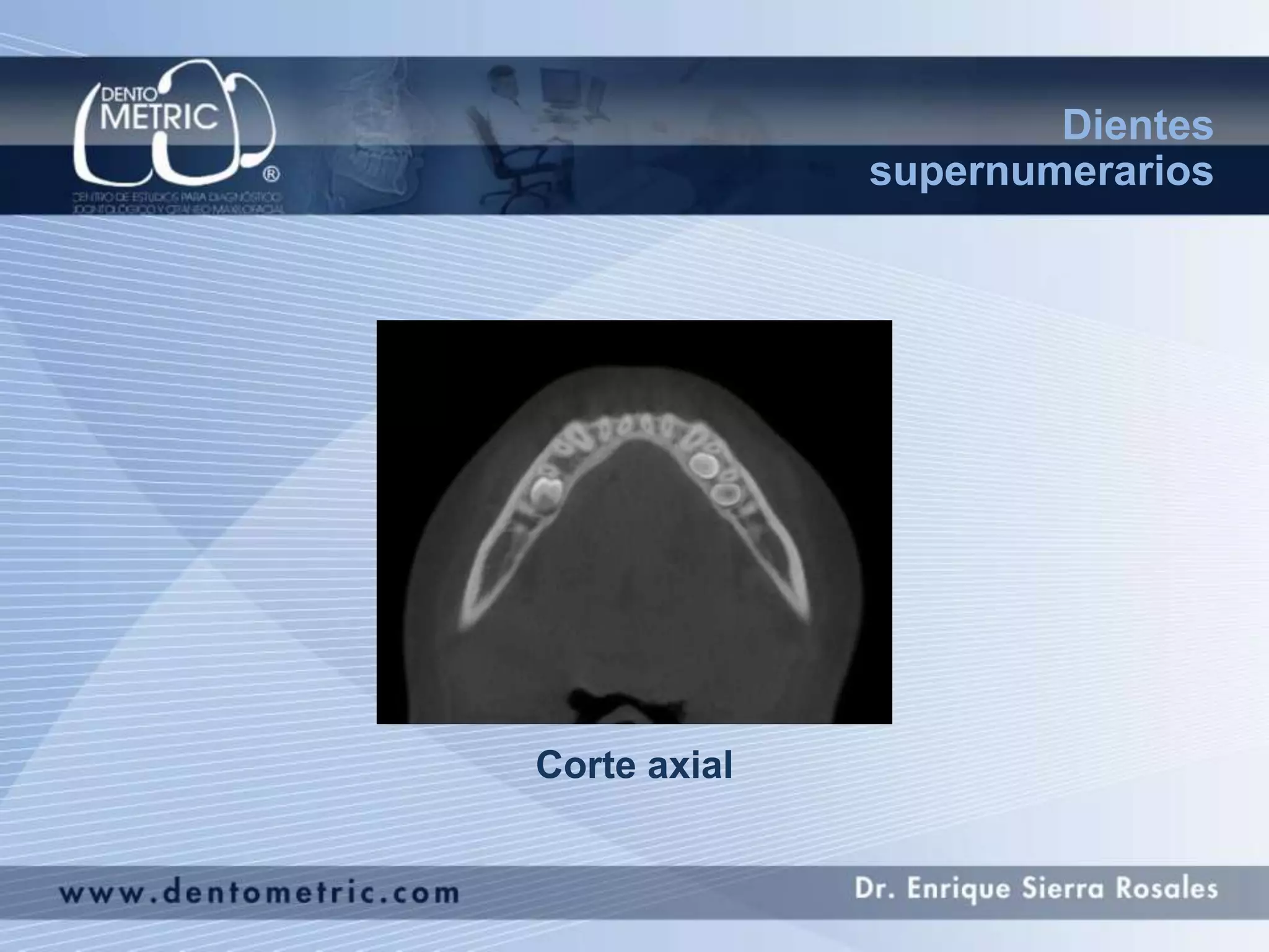 Dientes supernumerarios | PPT