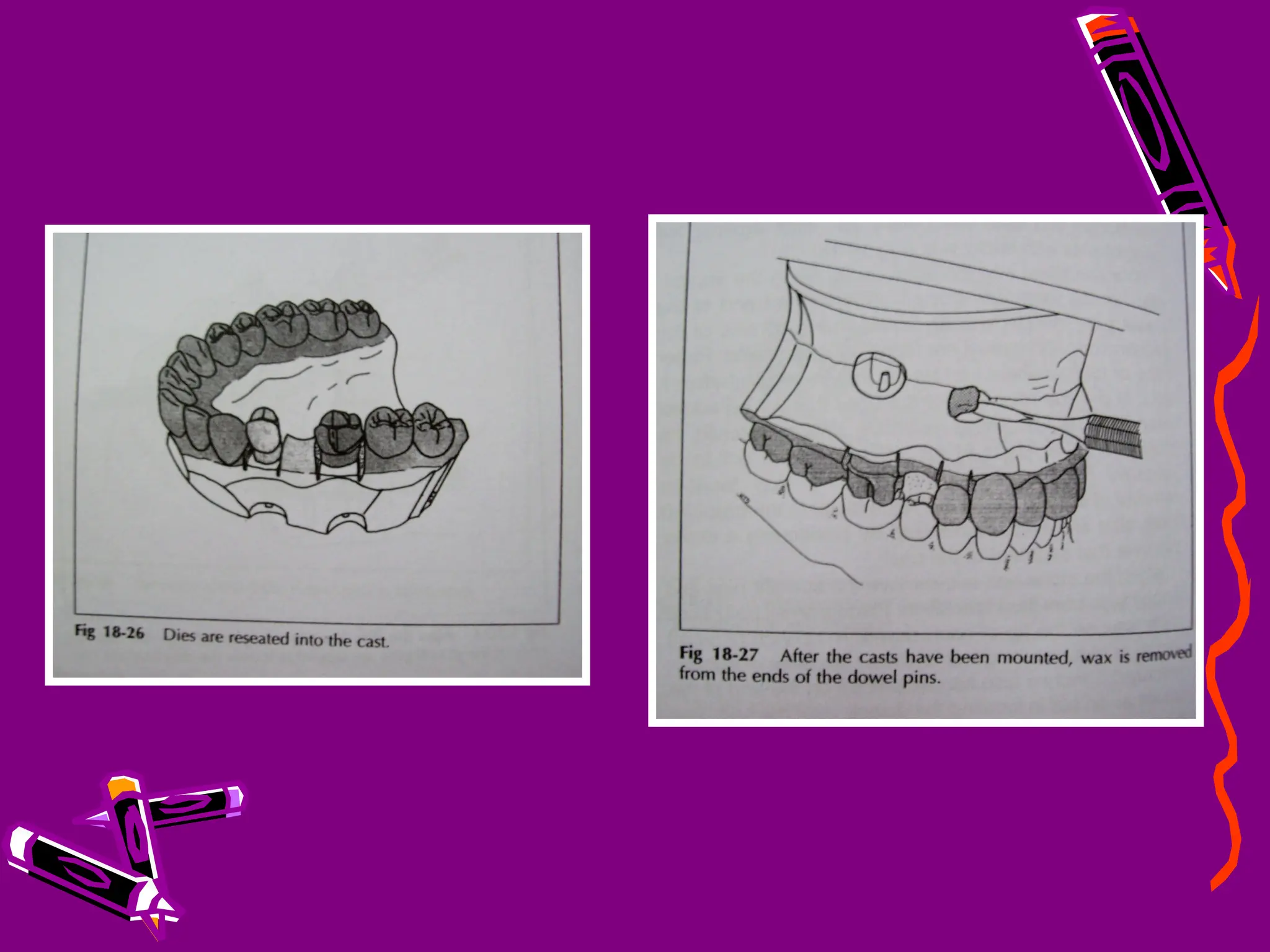 die ppt lecture prosthodontics and crown | PPT | Free Download
