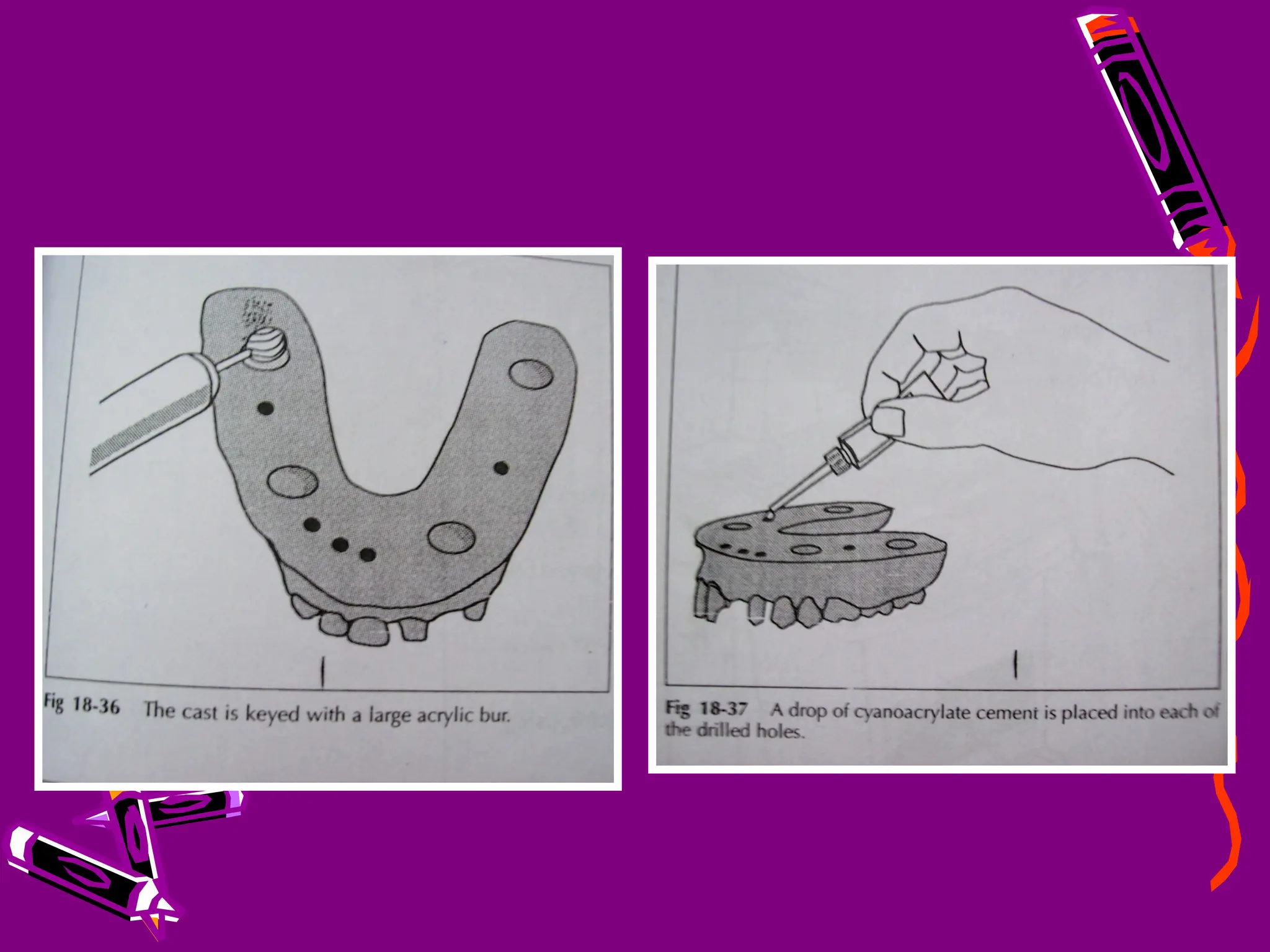 die ppt lecture prosthodontics and crown | PPT