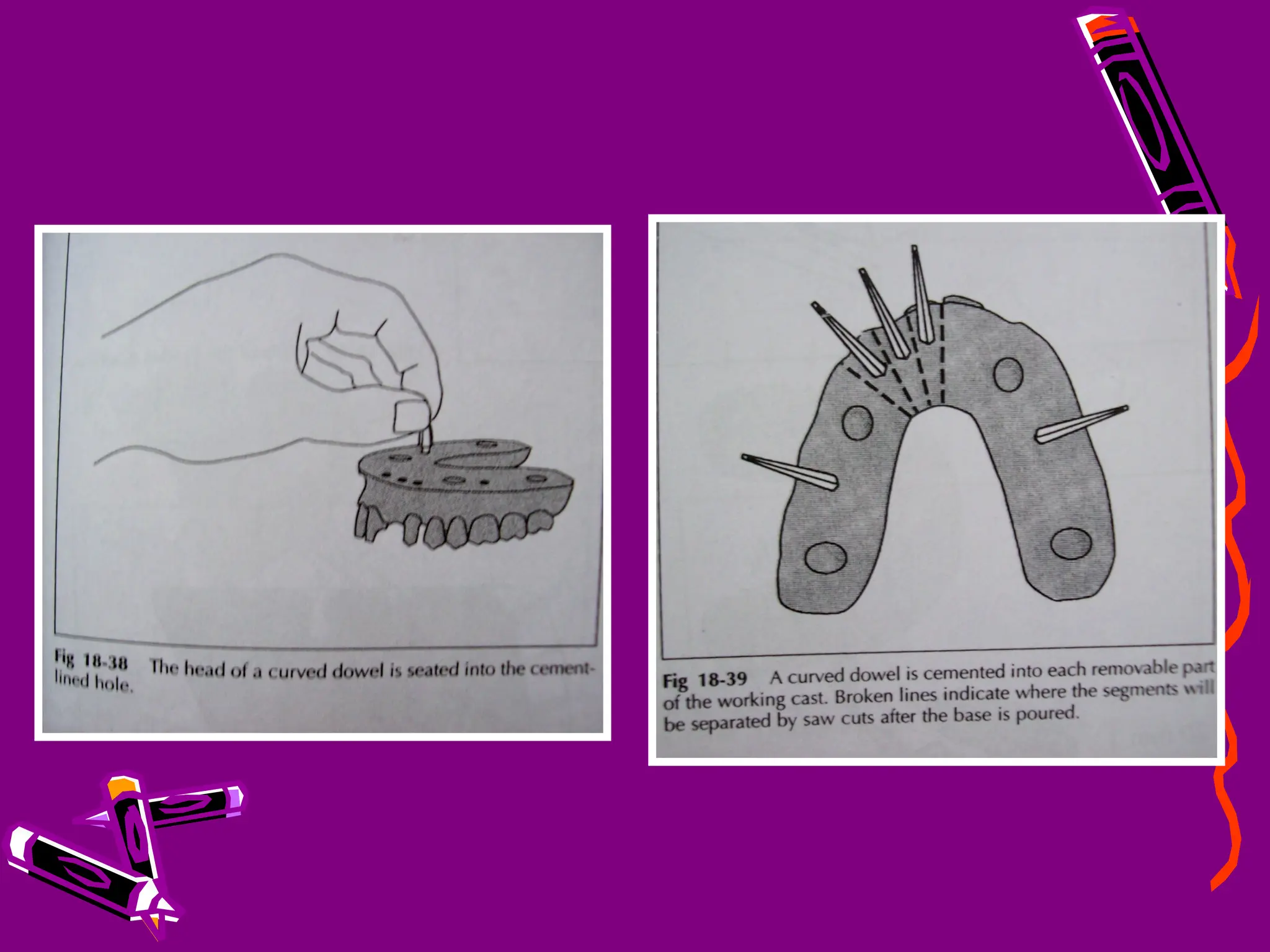 die ppt lecture prosthodontics and crown | PPT