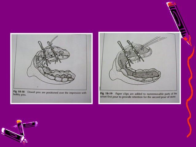 die ppt lecture prosthodontics and crown | PPT die ppt lecture prosthodontics and crown | PPT