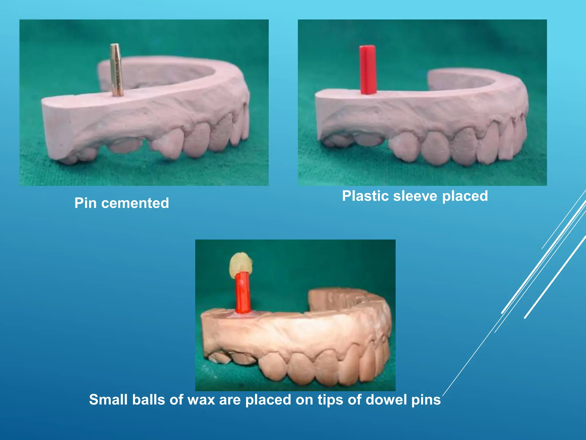 DIE SYSTEMS and die material in dentistry | PPTX