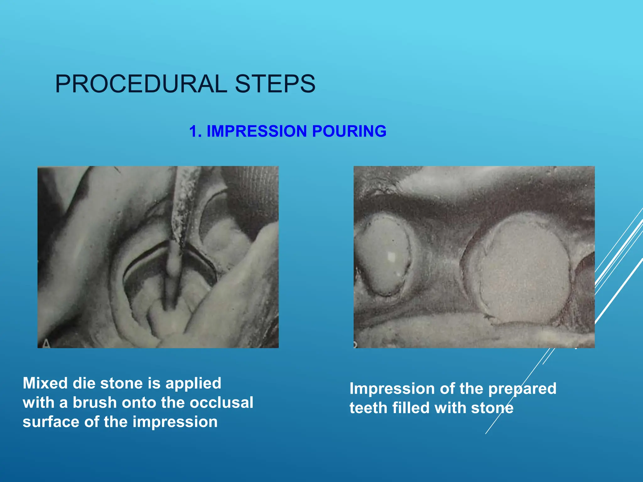 DIE SYSTEMS and die material in dentistry | PPTX