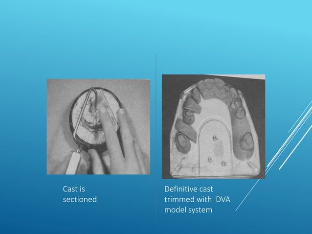 DIE SYSTEMS and die material in dentistry | PPTX | Oral care | Personal ...