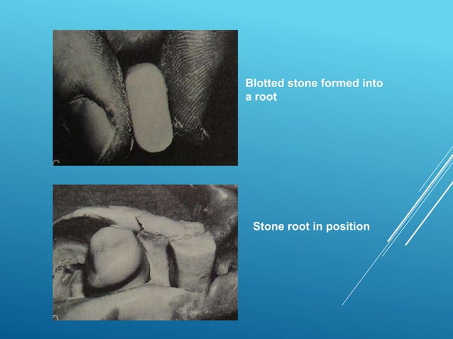 DIE SYSTEMS and die material in dentistry | PPTX | Oral care | Personal ...
