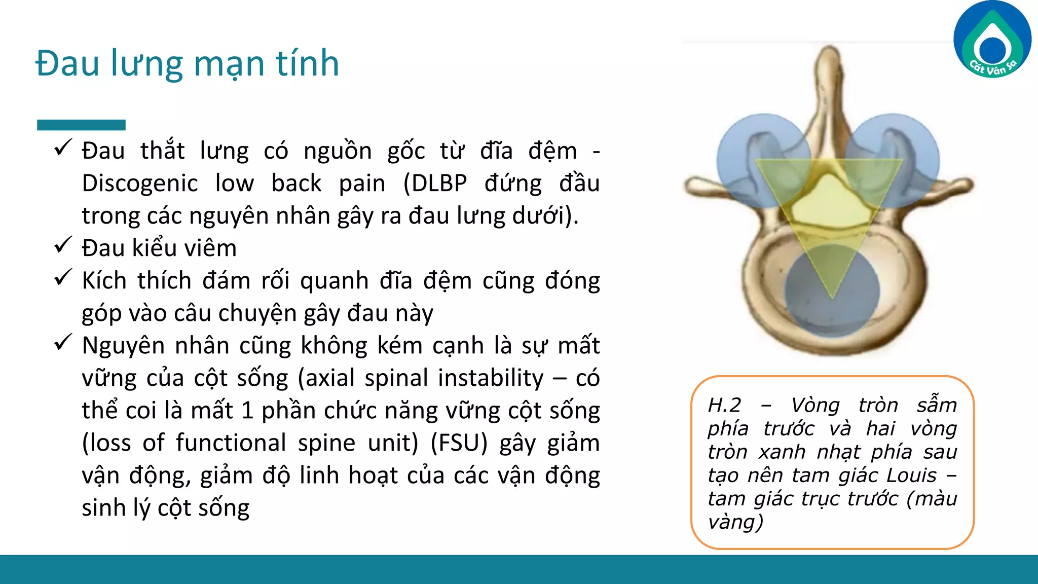 Điều Trị Đau Cột Sống Mạn Tính bằng Sóng Vô Tuyến Cao Tần RFA (Rafio ...