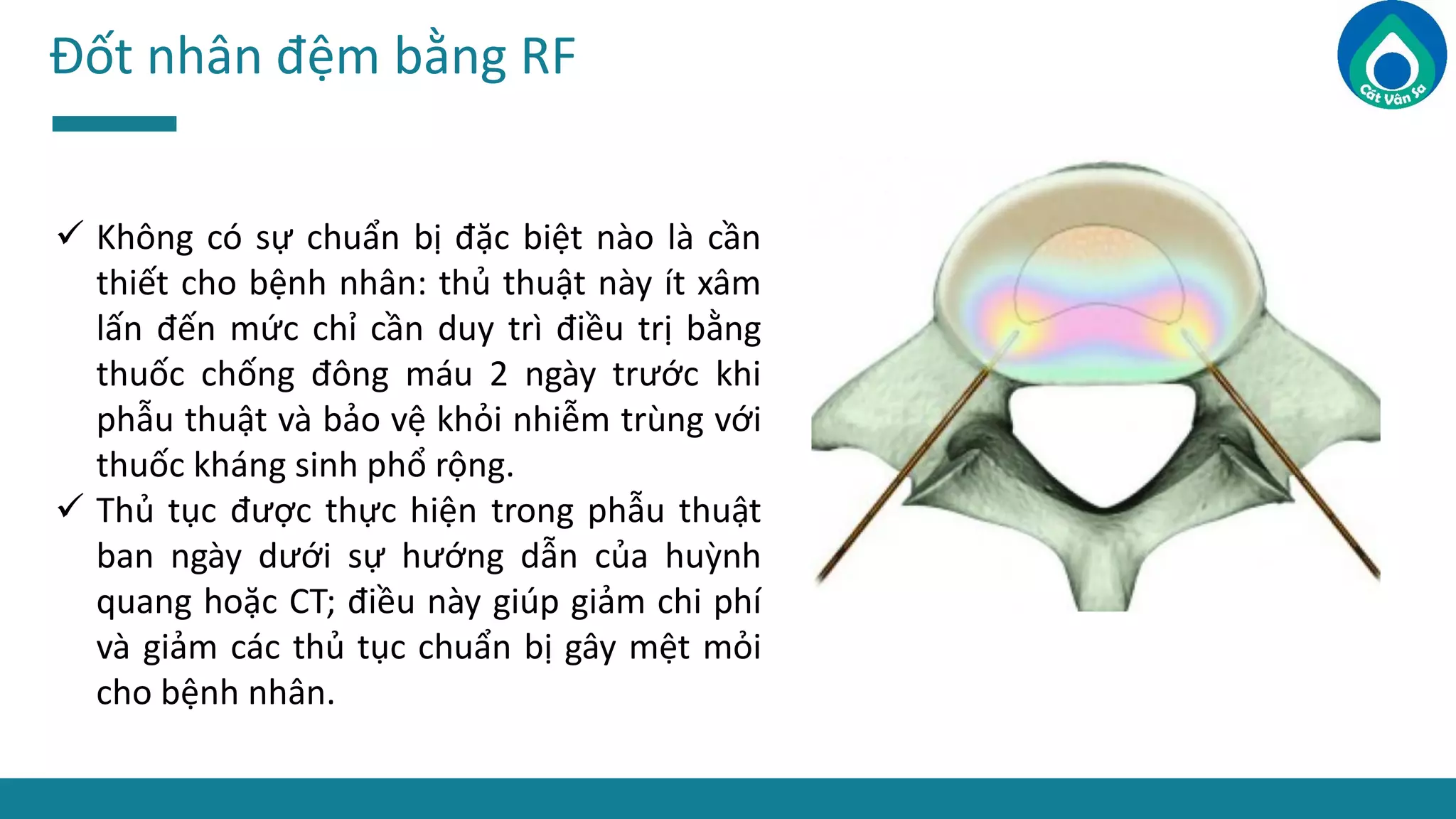 Điều Trị Đau Cột Sống Mạn Tính bằng Sóng Vô Tuyến Cao Tần RFA (Rafio ...
