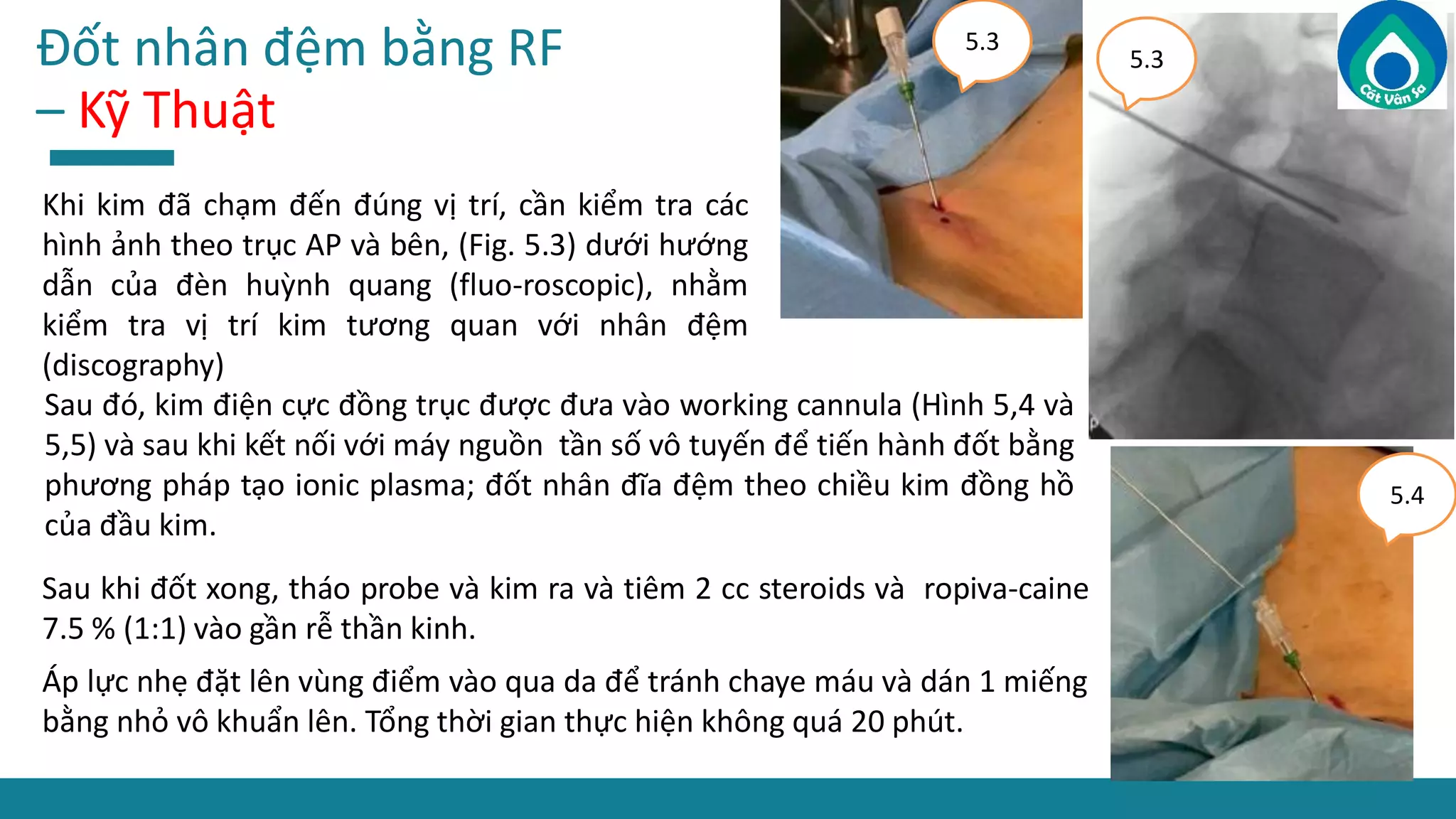 Điều Trị Đau Cột Sống Mạn Tính bằng Sóng Vô Tuyến Cao Tần RFA (Rafio ...