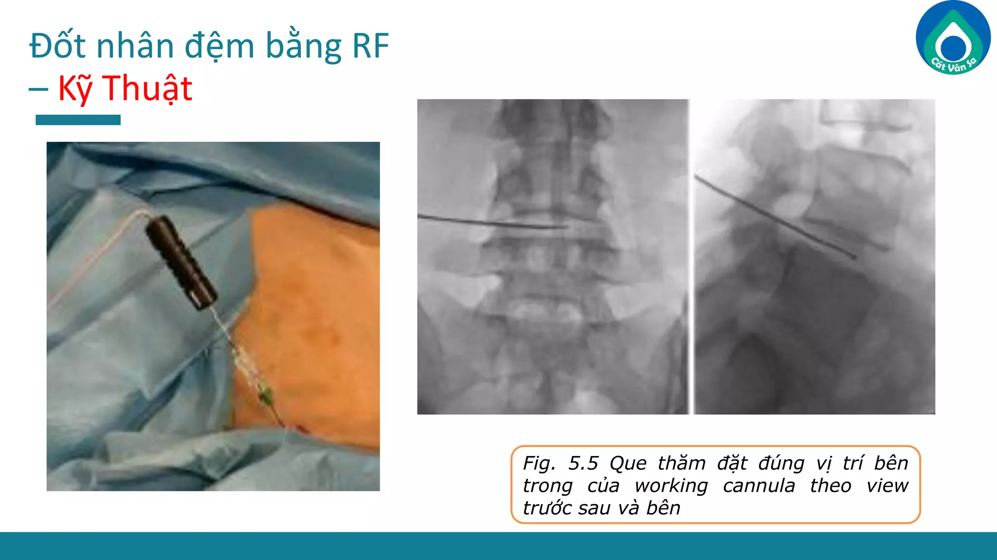 Điều Trị Đau Cột Sống Mạn Tính bằng Sóng Vô Tuyến Cao Tần RFA (Rafio ...