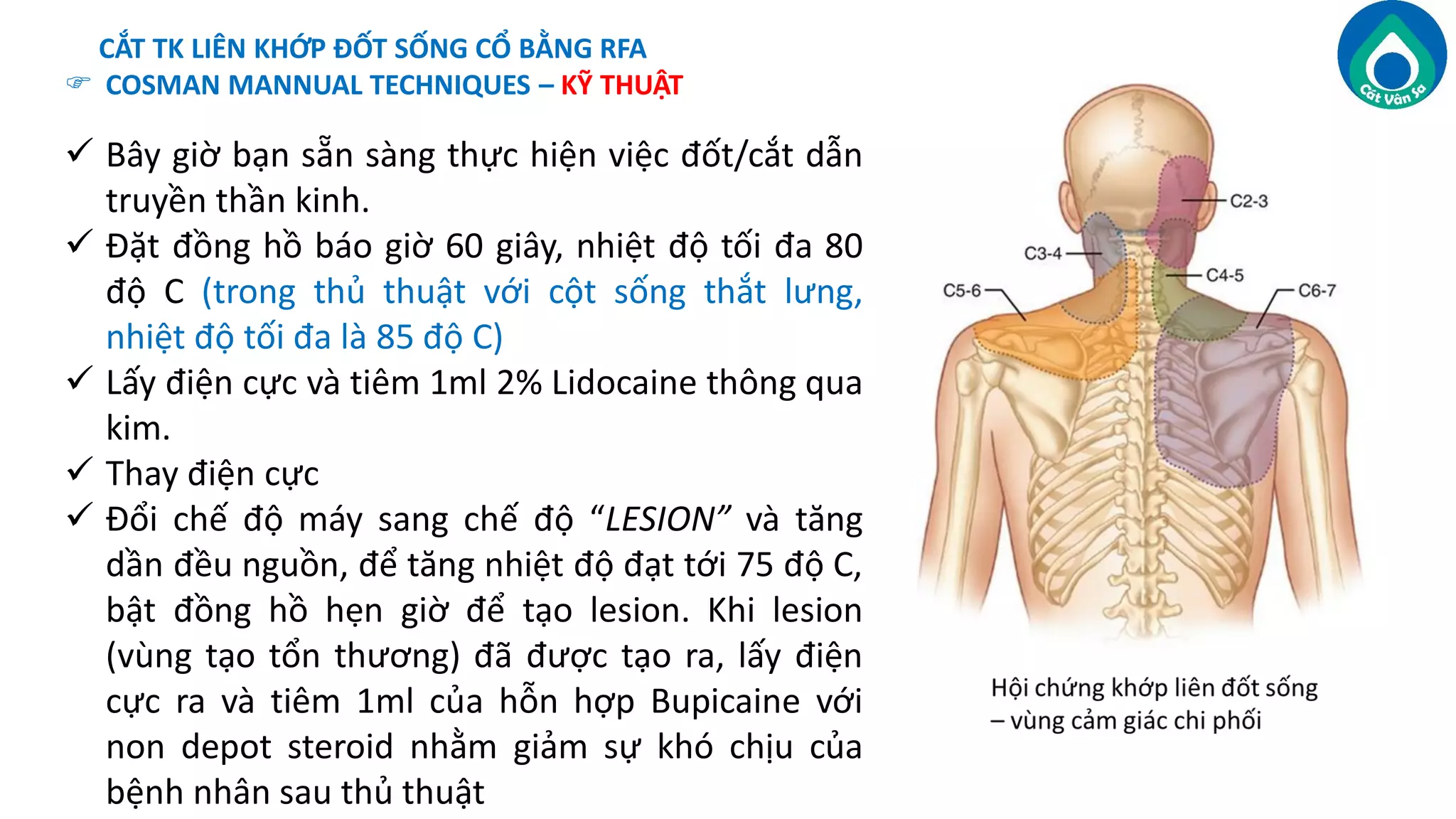 Điều Trị Đau Cột Sống Mạn Tính bằng Sóng Vô Tuyến Cao Tần RFA (Rafio ...