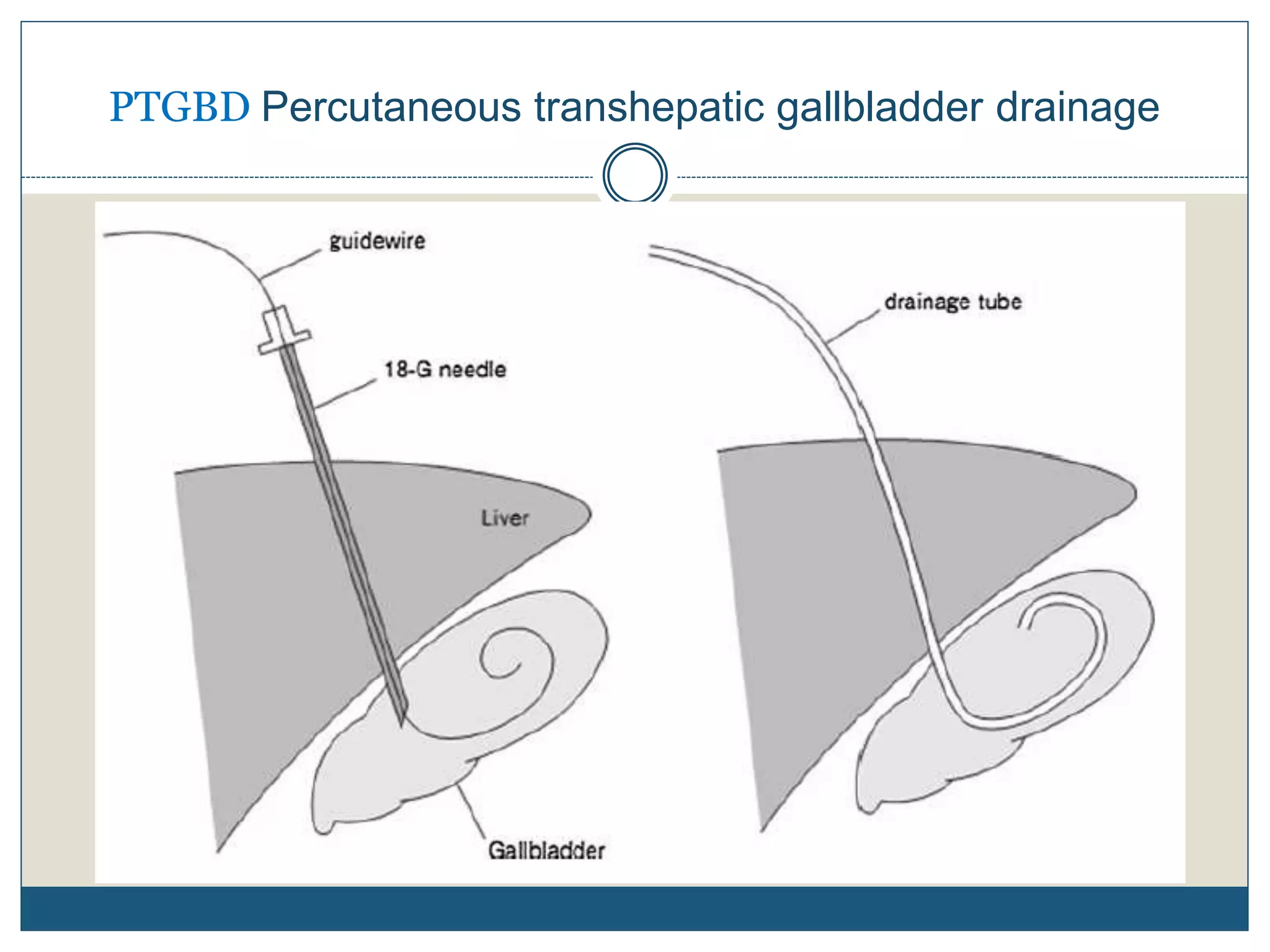 Điều trị sỏi mật và viêm túi mật - 2019 - Đại học Y dược TPHCM | PPT