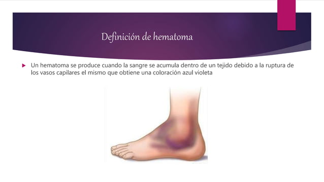 Equimosis O Hematoma