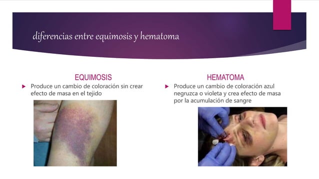 Equimosis O Hematoma