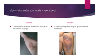 Equimosis O Hematoma