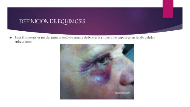Diferencia entre equimosis y hematoma