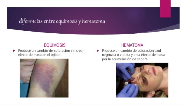 Equimosis O Hematoma