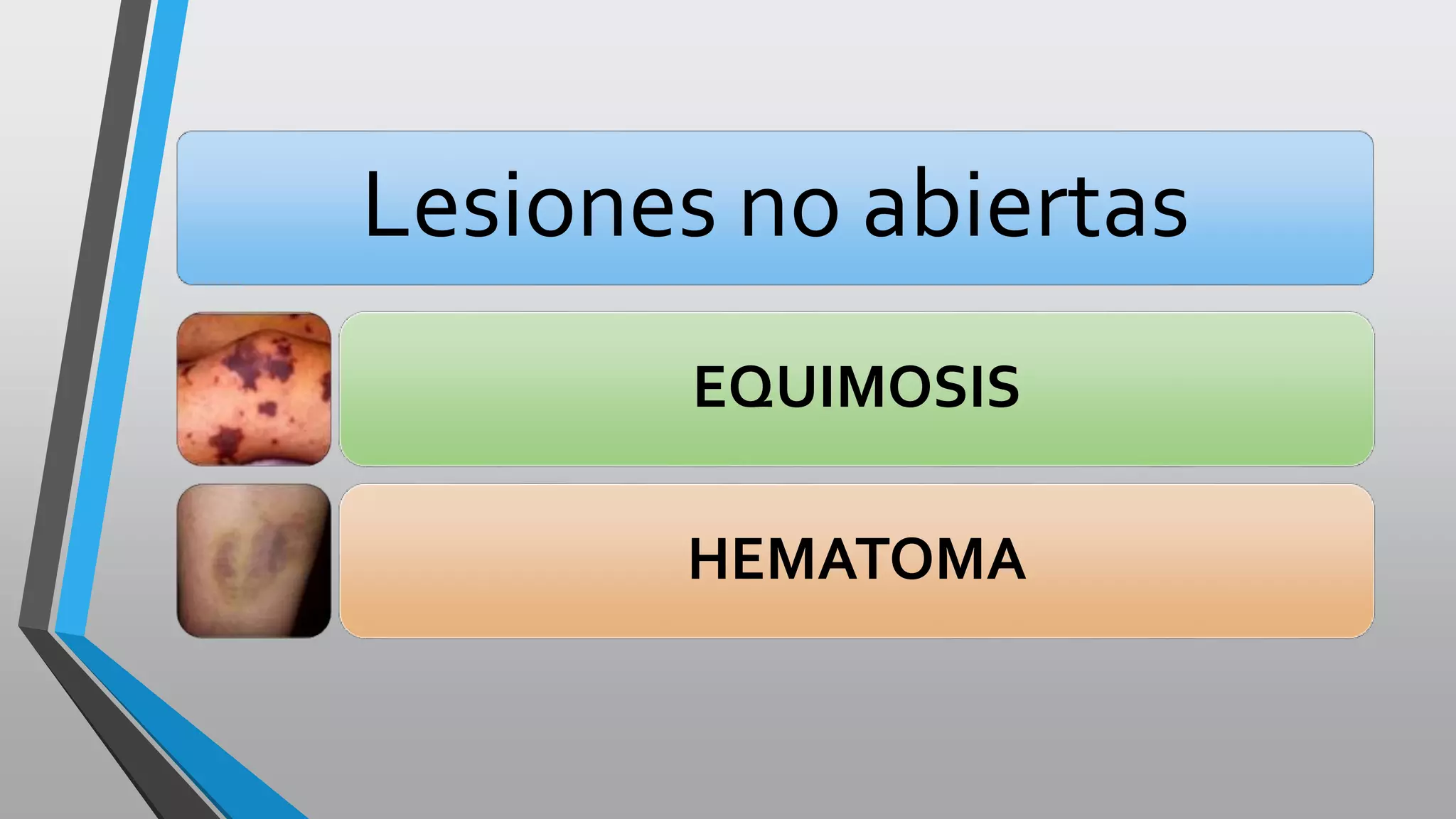 Diferencia entre equimosis y hematoma | PPT