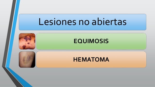 Equimosis O Hematoma