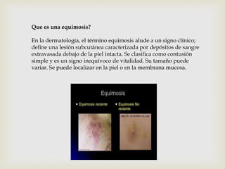 Diferencia entre hematoma y esquimosis | PPTX