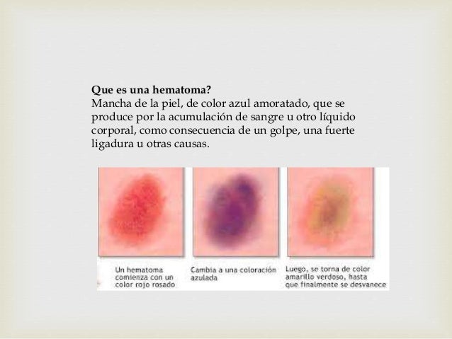 Diferencia entre hematoma y esquimosis