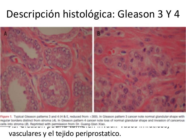Diferencia gleason 3 y 4